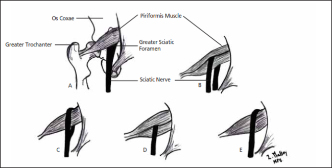 Piriformis Muscle: Low Back, Hip, Buttock, Pelvic, Thigh Pain - The ...
