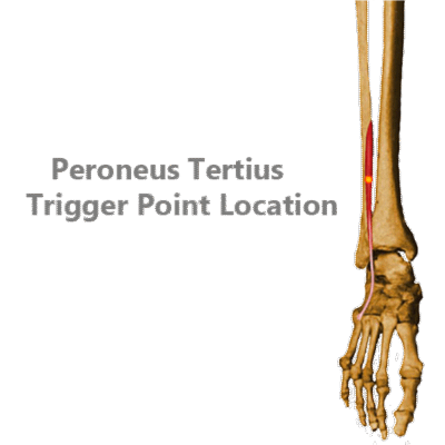 Peroneus Tertius: Ankle and Heel Pain - The Wellness Digest