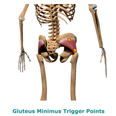 Muscle Trigger Points and How They Contribute To Muscle and Joint Pain ...